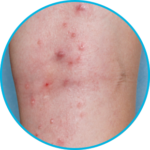 Efficacy | YCANTH™ (cantharidin) 0.7% topical solution