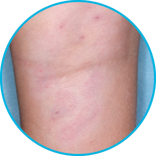 Efficacy | YCANTH™ (cantharidin) 0.7% topical solution