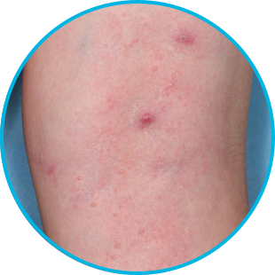 Efficacy | YCANTH™ (cantharidin) 0.7% topical solution