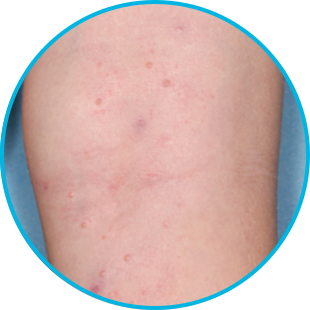 Efficacy | YCANTH™ (cantharidin) 0.7% topical solution