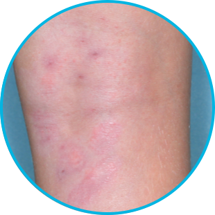 Efficacy | YCANTH™ (cantharidin) 0.7% topical solution