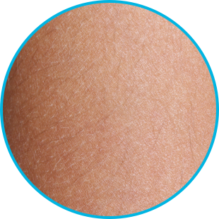 Efficacy | YCANTH™ (cantharidin) 0.7% topical solution