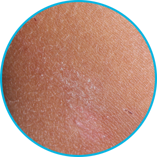 Efficacy | YCANTH™ (cantharidin) 0.7% topical solution